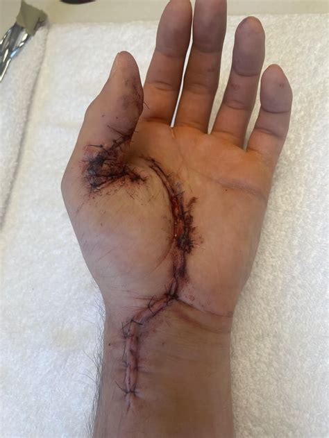Severed My Flexor Tendon With Glass From A Broken Bottle Before And