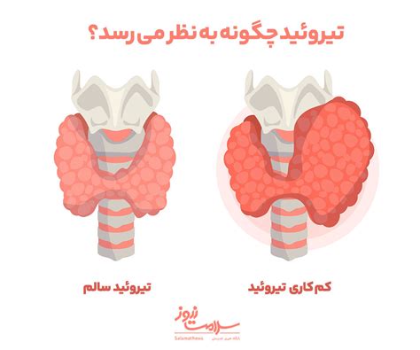 مبتلایان به کم کاری تیروئید نباید این غذاها را هرگز بخورند
