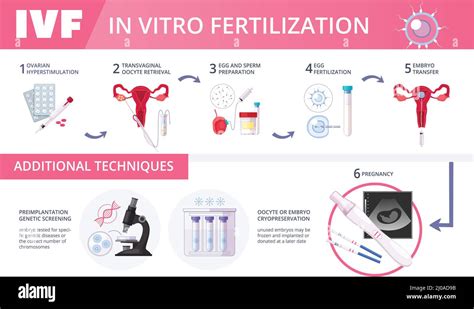 In Vitro Fertilization Steps