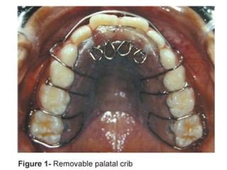 Tongue Crib Ppt