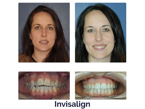 Before After Orthodontic Treatment Baton Rogue La Porter Orthodontics