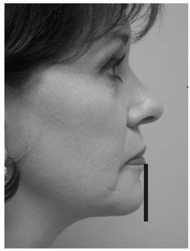 The Aging Neck Ento Key