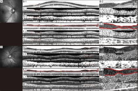 Detection Of Localized Retinal Nerve Fiber Layer Defects In Glaucoma
