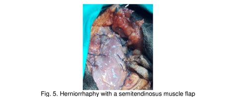Simple Herniorrhaphy Fig 4 Herniorrhaphy By Transposition Of The