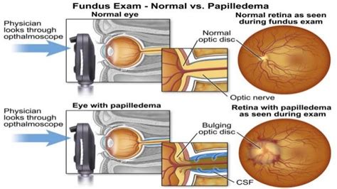 Papilledema Vs Papillitis With Notes Timothy Zagada