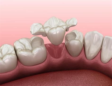 Resin Bonded Maryland Bridge London Specialist Dentists