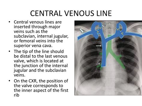 Lines And Tubes In Xray Pptx