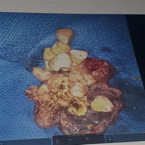 19y O Male My Gallbladder Removal Was Told By My Surgeon Who Removed