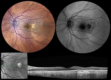 Epidemiology Of Geographic Atrophy And Its Precursor Features Of