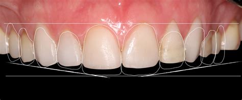 Diseño De Sonrisa Madrid Clínica Dental Dr Tomás Hernán