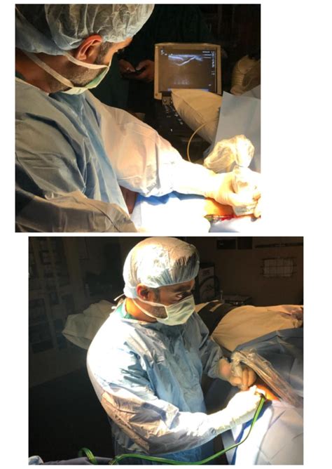 Percutaneous Extensor Carpi Radialis Brevis Tendon Repair Tennis Elbow Minimal Incision