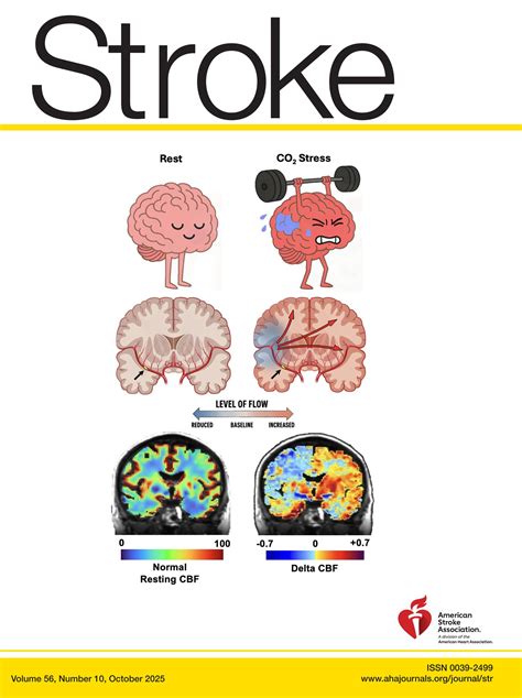 Guidelines In Action The Multifactorial Nature Of Ischemic Stroke In Malignancy Stroke