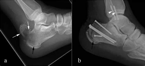 Calcaneus Radiology
