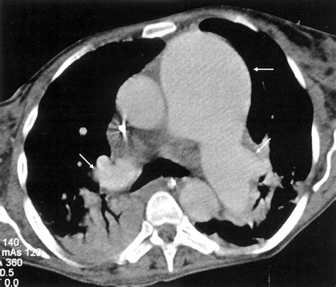 Klippel Trenaunay Weber Syndrome Circulation