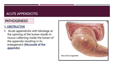 Acute Appendicitis Anatomy Aetiology Types Clinical Featurespptx