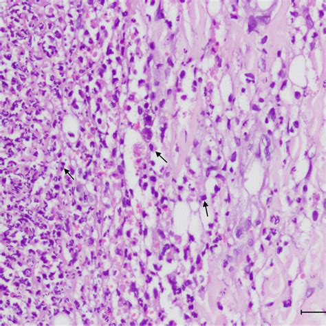 Microscopic View Of Mixed Chronic Inflammation Of The Sacrificed Rat On
