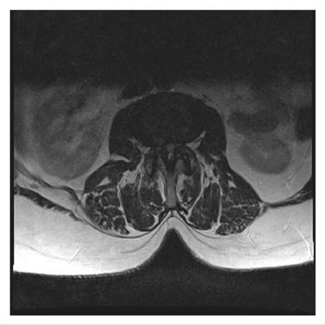 Mri Grading System For Lumbar Foraminal Stenosis Download Table