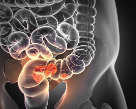Global Carbon Nanoparticles Lymphatic Tracer Market Revenue Is Expected