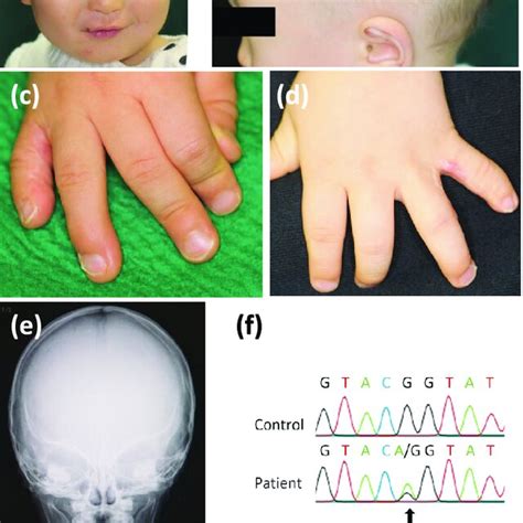 Clinical Features Of The Present Patient A B The Patient Shows
