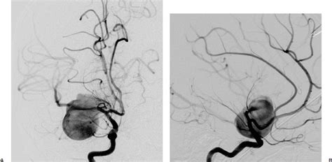 Intracranial Intracranial Bypass With Interposition Graft Neupsy Key