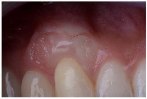 Complications In The Use Of Deepithelialized Free Gingival Graft Vs
