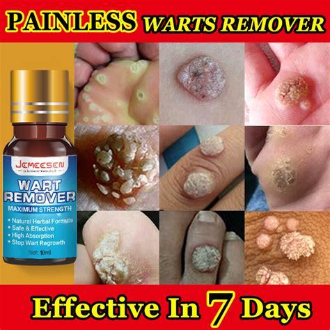 Who Removes Warts On Face At Judith Poche Blog