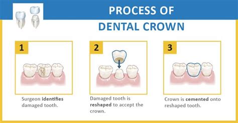 Dental Crown Is A Tooth Shaped Cap Placed Over A Tooth It Is Used To