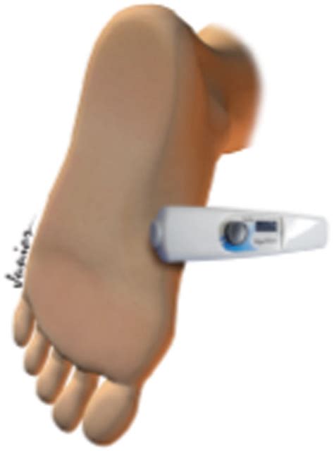 Objective Evaluation Of Plantar Hyperhidrosis After Sympathectomy Clinics