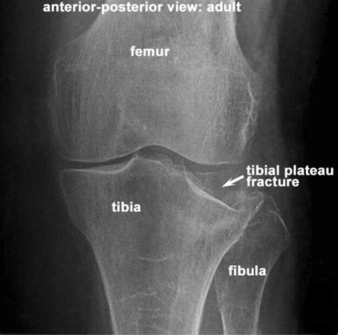 Fracture Differential Diagnosis Of The Knee