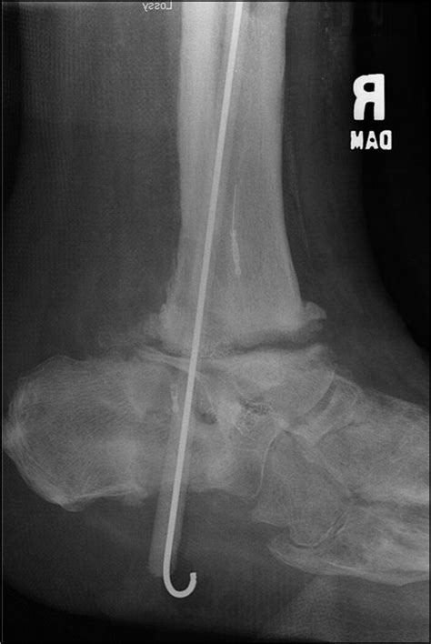 Antibiotic Coated Intramedullary Rod The Journal Of Foot And Ankle