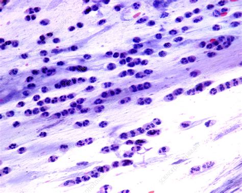 Sputum Smear In Acute Bronchitis Light Micrograph Stock Image C059 5052 Science Photo Library