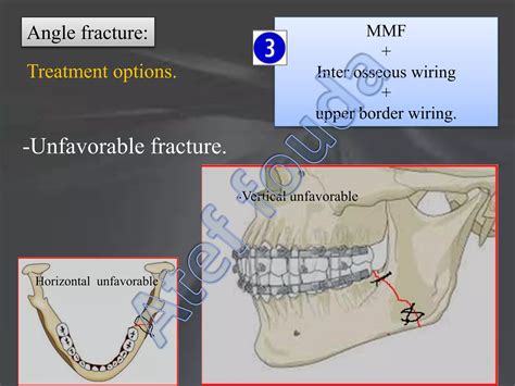 Fracture Mandibular Angle Ppsx