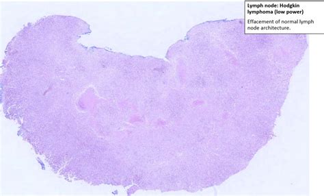 Lymph Node Hodgkin Lymphoma Nus Pathweb Nus Pathweb