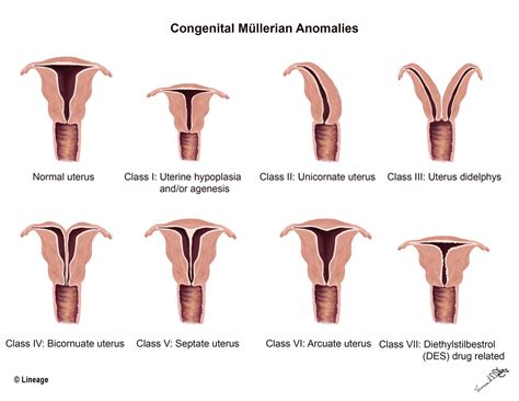 Miscarriage Reproductive Medbullets Step 1