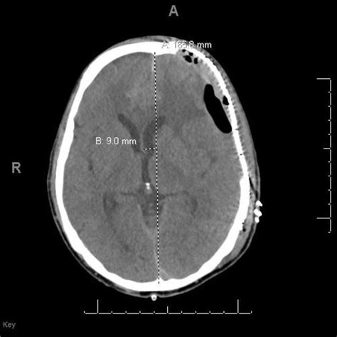 Ct Head Post Thoracotomy With Expansion Of Contusion With Shift