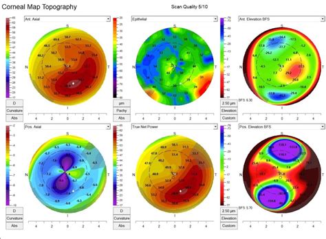 Transforming Care And Efficiency In Optometry The Topography Technology