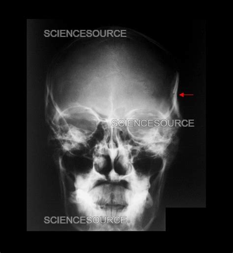 X Ray Of Skull Fracture Stock Image Science Source Images