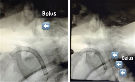 Vfss Swallow Sequence Of Thin Liquids With Strategies Prior To