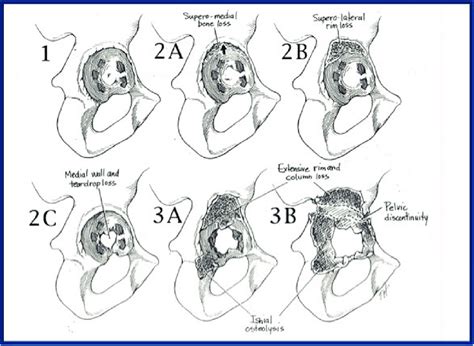 Paprosky Classification Of Acetabular Deficiencies Download Scientific Diagram
