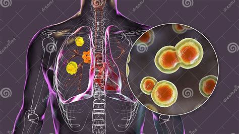 Pulmonary Blastomycosis 3d Illustration Stock Illustration
