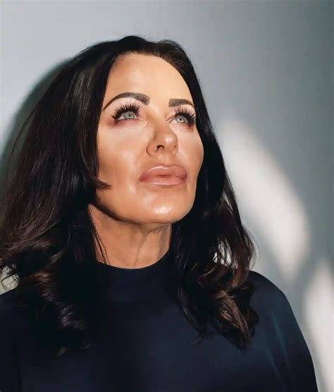 Botox Gone Wrong Forehead