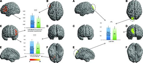 Comparison Of Gray Matter Volume Gmv Between The Patients With Right Download Scientific