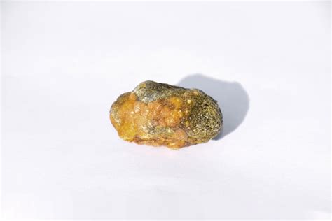 Premium Photo Stone Of Gallbladder The Result Of Gallstones A