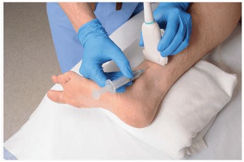 Ultrasound Guided Superficial Peroneal Nerve Block At The Ankle