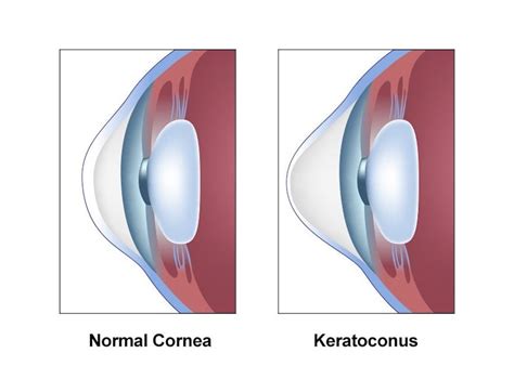 Keratoconus Treatment In Providence Ri Galler Eyecare Associates