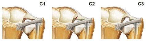 Tfcc New Classification · Msk Radiology