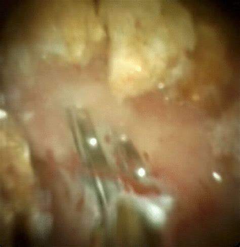 Cholangioscopy Showing Two Surgical Clips Migrated Into The Choledochal Download Scientific