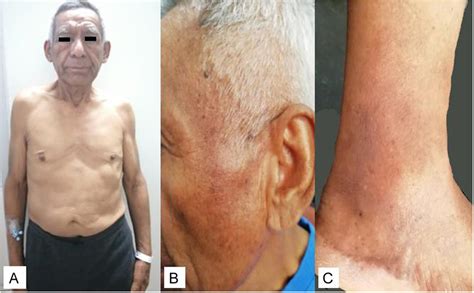 Clinical Manifestations Of The Patient A Abdominal Lipodystrophy And