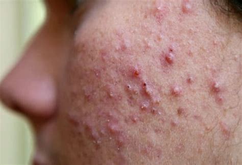 Boils Pictures On Skin Causes And Treatment