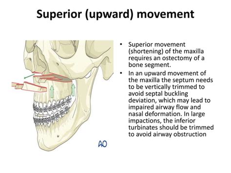 Le Fort I Maxillary Osteotomy Pptx